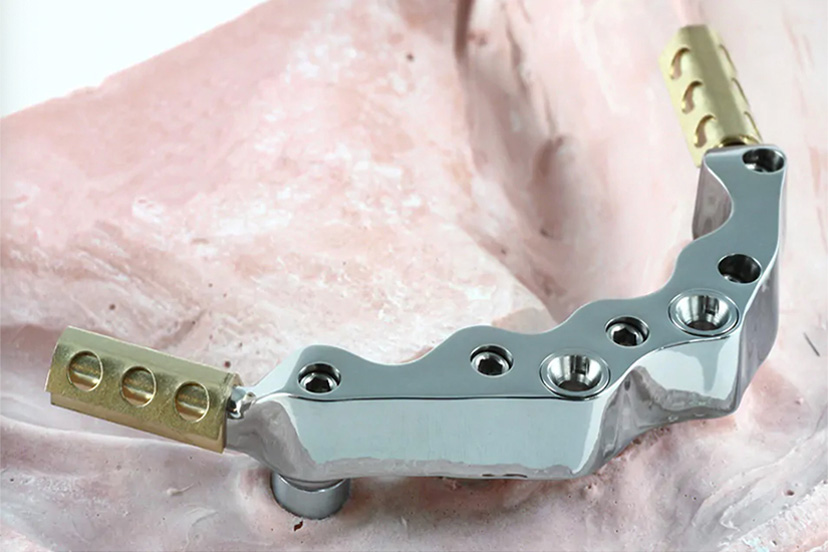 Implants bars - Laboratoire Dentaire Laval Lafond Desjardins